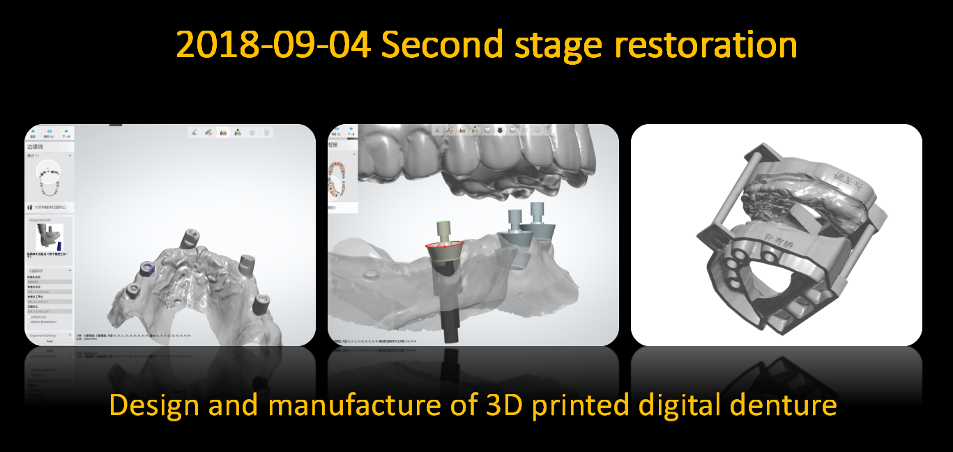 Application case of 3d digital printing implanting technology in the ...